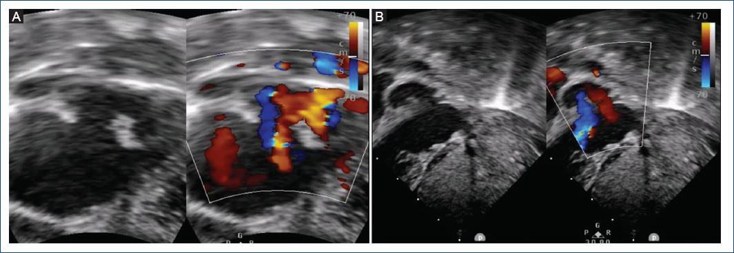 Double "dynamic" balloon atrial septostomy. New modification of Dr ...