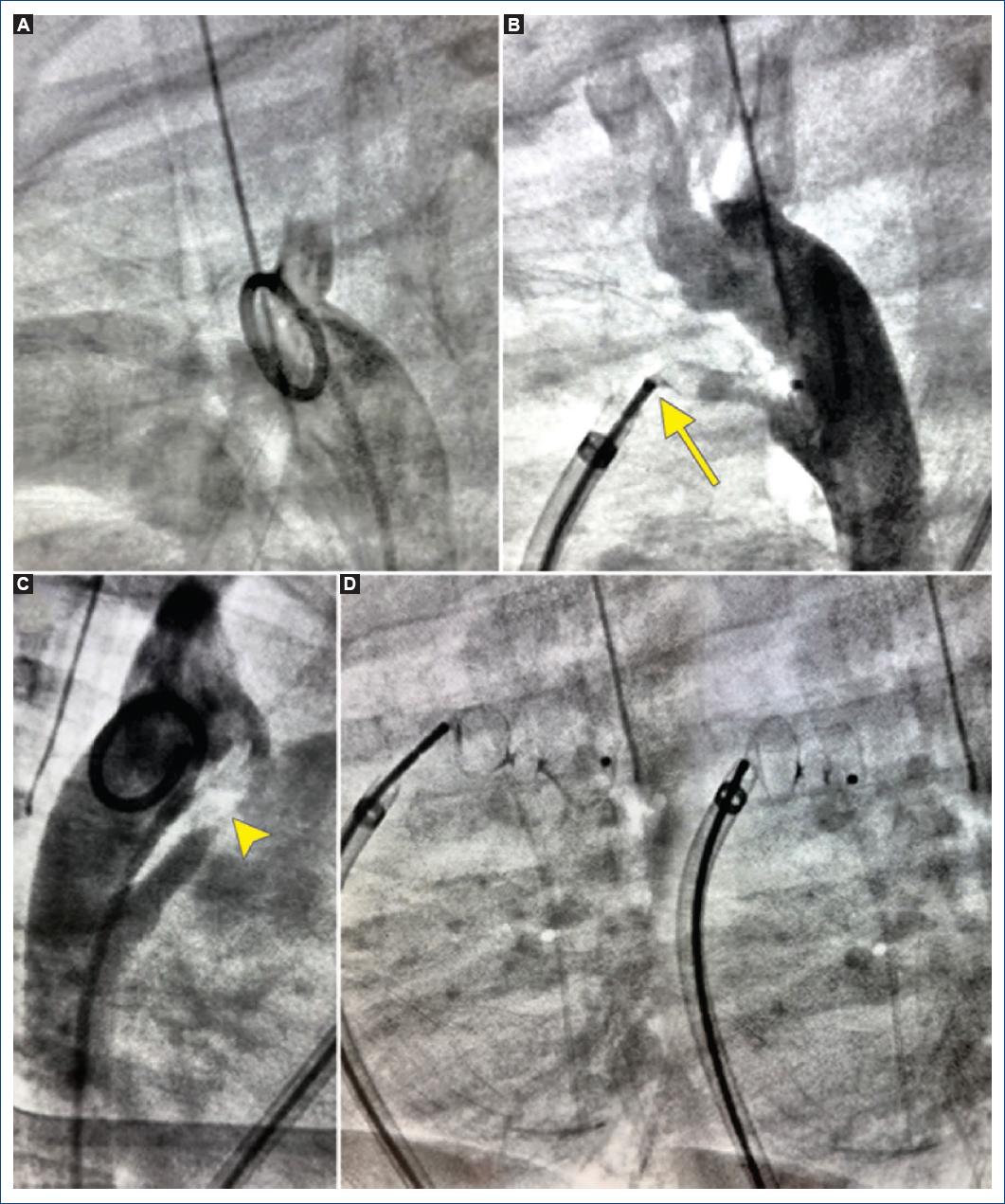 Ductal spasm versus angiographic variations during patent ductus ...