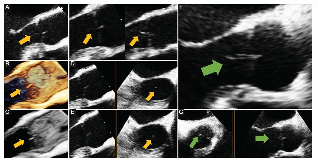 Lambl’s excrescence on the aortic valve