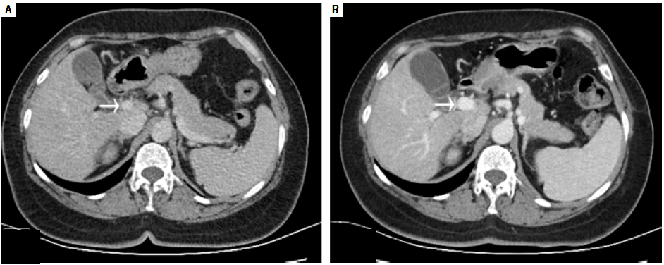 Recurrent Hyperammonemia After Abernethy Malformation Type 2 Closure: a ...