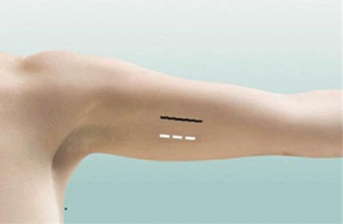 Location and removal of non-palpable subdermal single-rod contraceptive ...