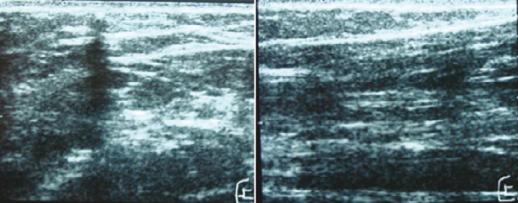 Location and removal of non-palpable subdermal single-rod contraceptive ...