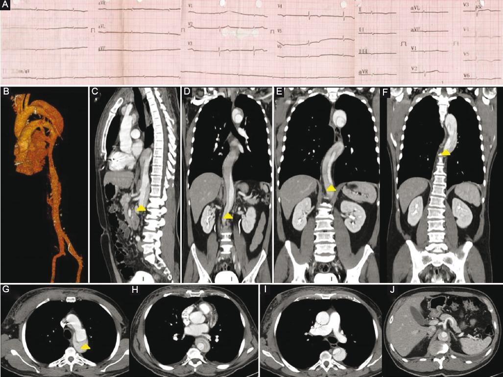 Complete atrioventricular block as an initial manifestation of aortic ...