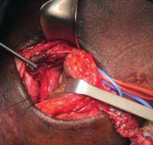 Anterolateral thigh versus radial forearm flap for cervical esophageal ...