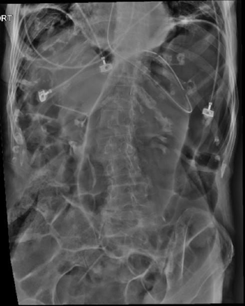 Synchronous volvulus of the cecum and sigmoid colon: a rare cause of ...