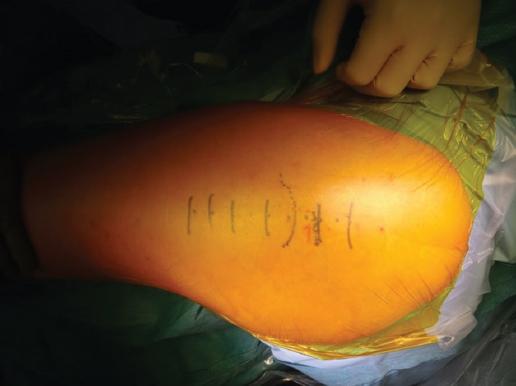 Comparison of early complications for primary total hip arthroplasty ...