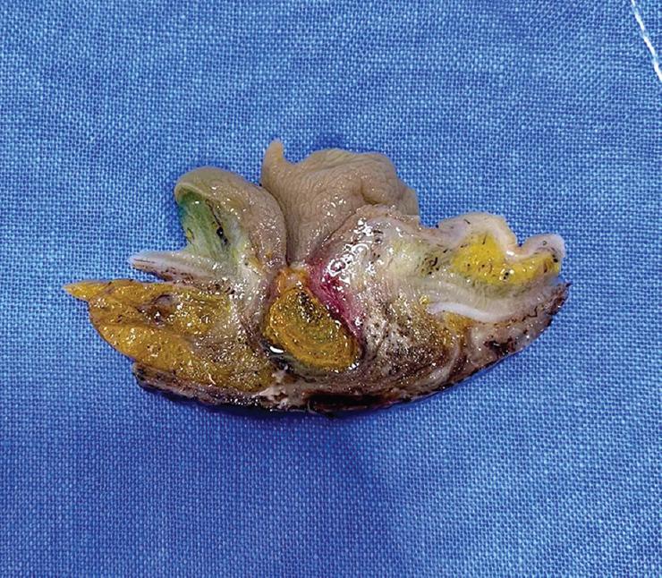Diverticulitis aguda purulenta en el ciego: reporte de caso