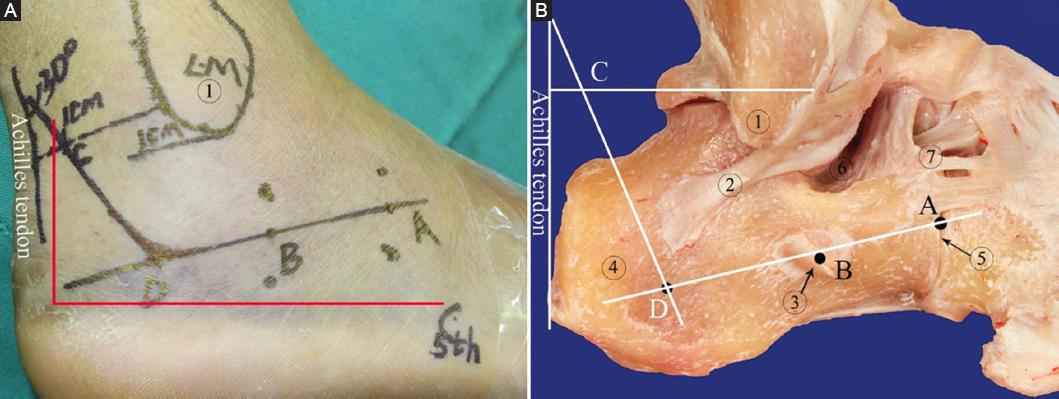 Modified extensile calcaneal exposure is safe