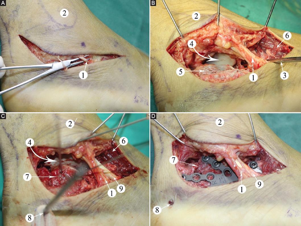 Modified extensile calcaneal exposure is safe
