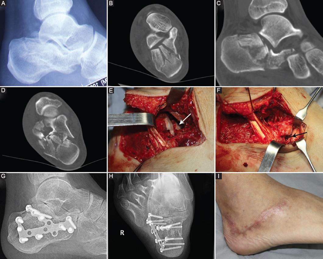 Modified extensile calcaneal exposure is safe