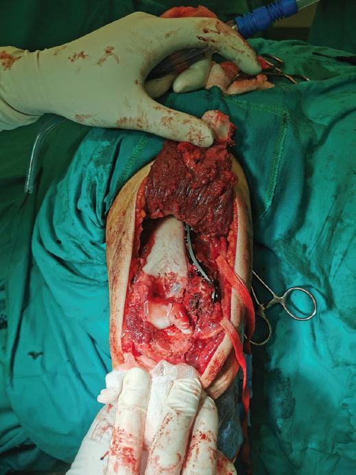Morphology of ulnar trochlear notch and defining ideal position for ...