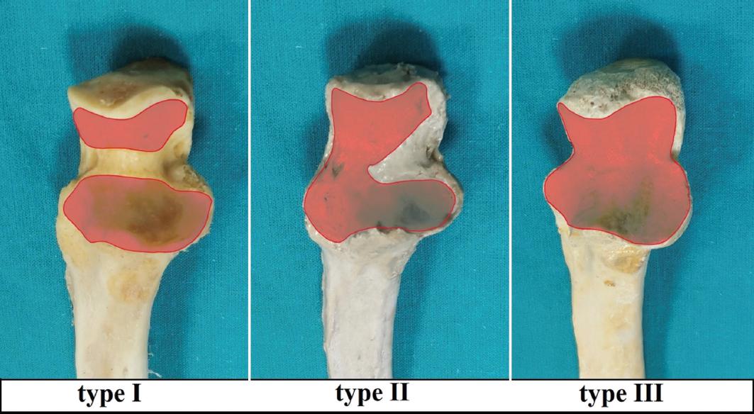Morphology of ulnar trochlear notch and defining ideal position for ...