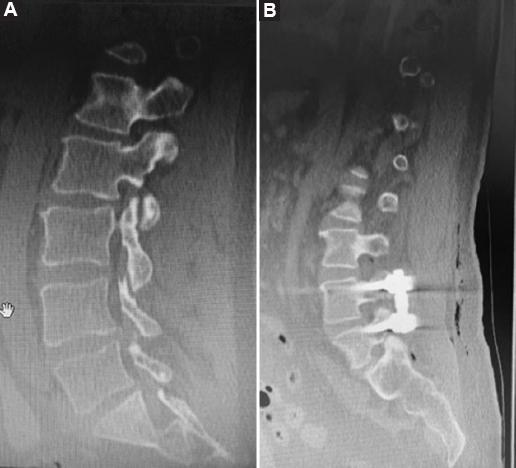Comparison posterior lumbar stabilization with dynamic rod system and ...