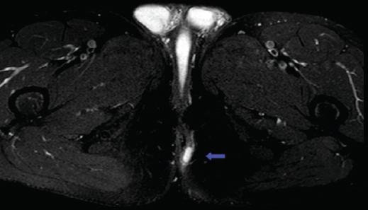 Sinus pilonidal de localización perianal. Difícil diagnóstico ...