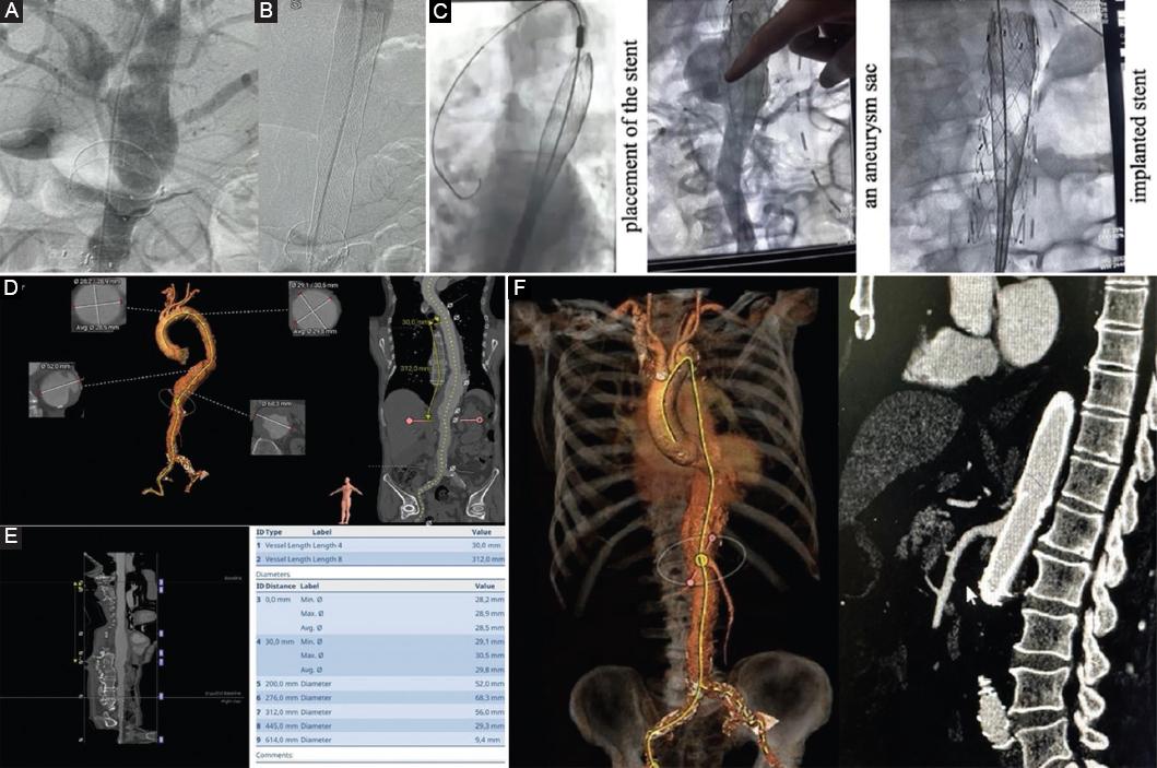 Multilayer flow modulator stents in aortic aneurysms: an overview based ...
