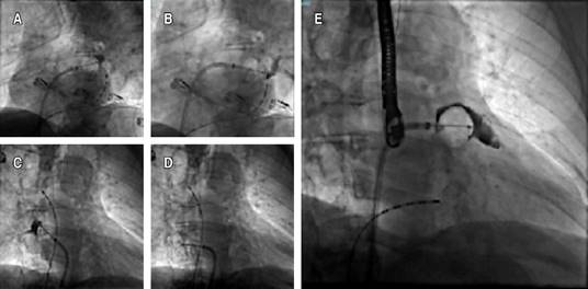 Cryoablation and left atrial appendage closure for atrial fibrillation ...