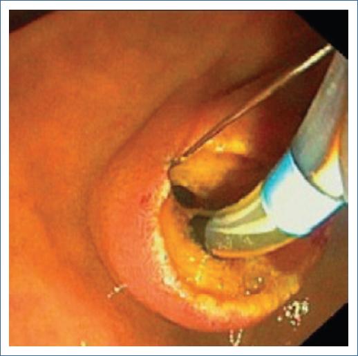 Esfinterotomía endoscópica y coledocolitiasis: aspectos básicos