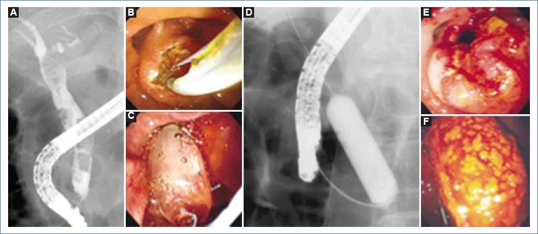 Esfinterotomía endoscópica y coledocolitiasis: aspectos básicos