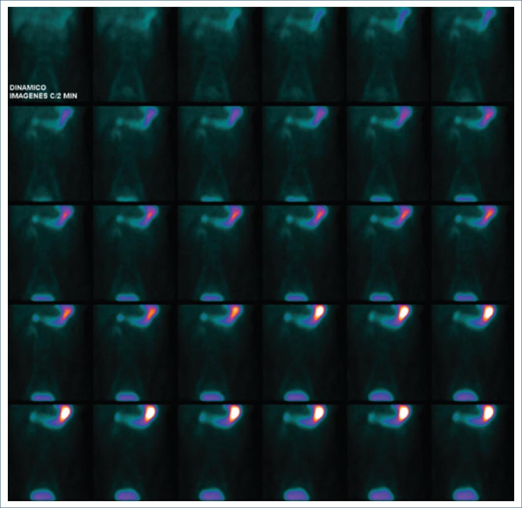 Meckel´s diverticulum diagnosed by capsule endoscopy
