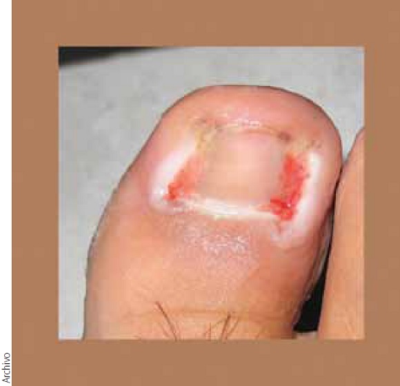 Matricectomía: Caso de la CONAMED