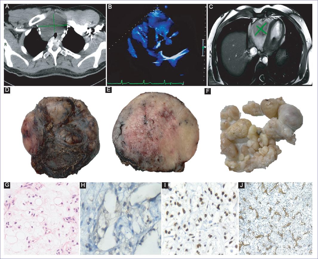 Manejo quirúrgico de un liposarcoma mixoide cervical con extensión ...