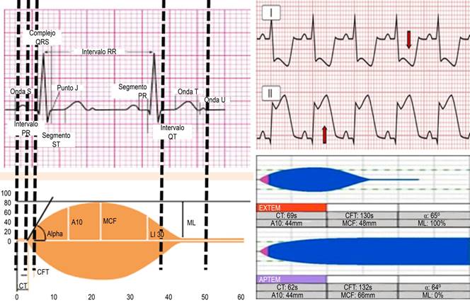 Tromboelastometría rotacional, el electrocardiograma de la coagulación