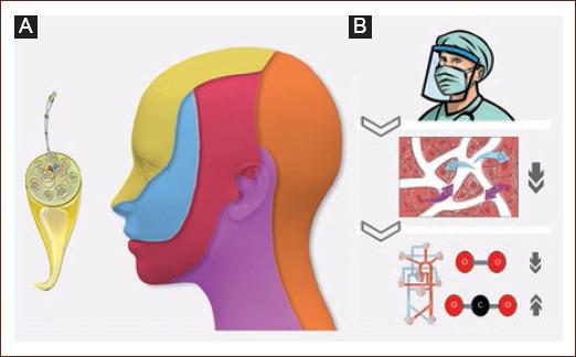 External compression headache: A neglected headache