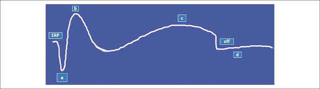 Molecular basis for interpretation of fulfilled electroretinographic ...