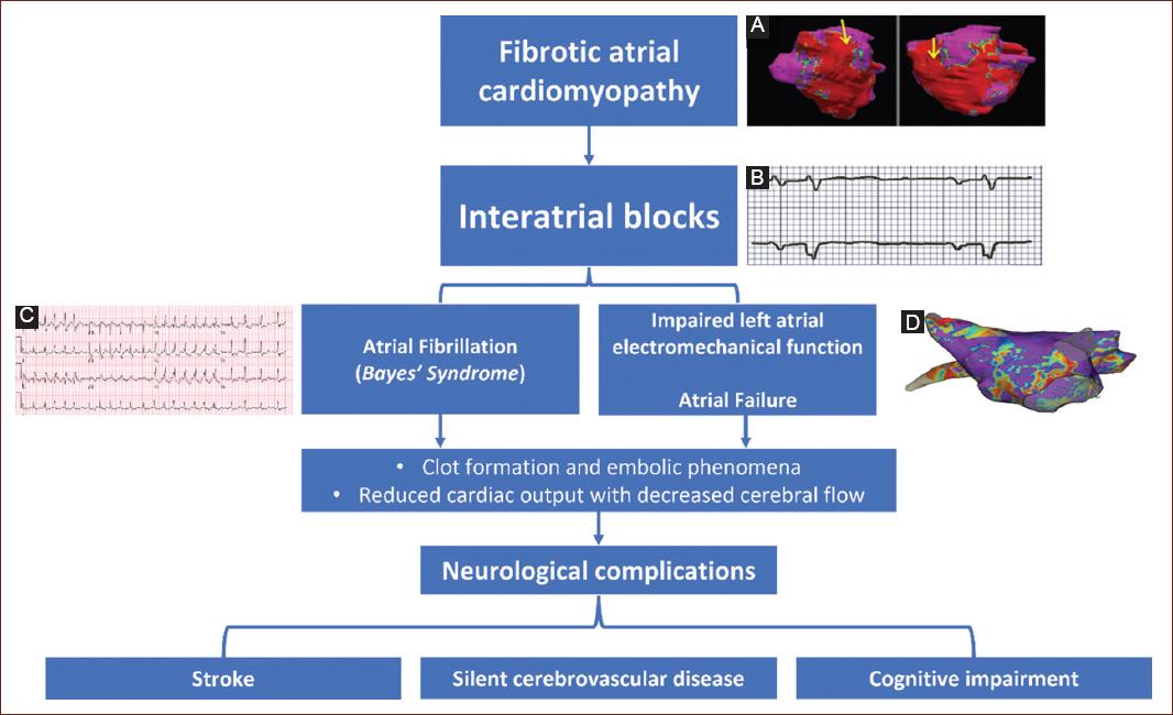 Neurological complications of interatrial blocks and Bayes’ syndrome