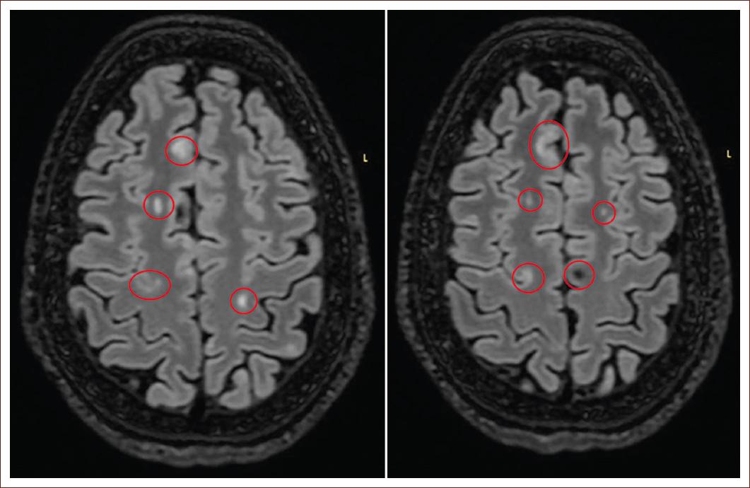 Location and morphology of cortical lesions in multiple sclerosis