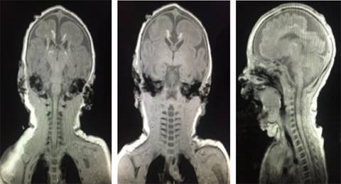 Microcefalia asociada a síndrome de transfusión feto-fetal