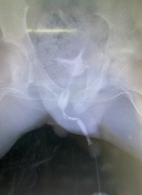 Tratamiento de estenosis de uretra anterior con balón dilatador con ...