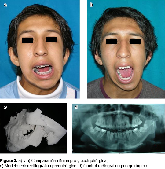 Anquilosis temporomandibular. Liberación, reconstrucción con injerto de ...