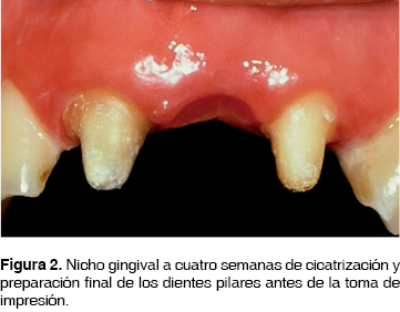 Diseño de póntico ovoide mediante contorno gingival: Reporte de dos ...