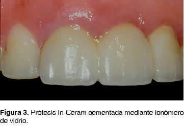 Diseño de póntico ovoide mediante contorno gingival: Reporte de dos ...