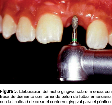 Diseño de póntico ovoide mediante contorno gingival: Reporte de dos ...
