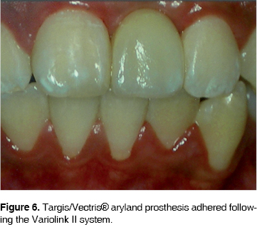 Ovoid pontic design through gingival contour: Report of two cases