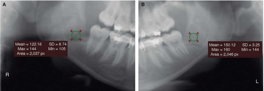 Gingival and bone tissue healing in lower third molar surgeries ...