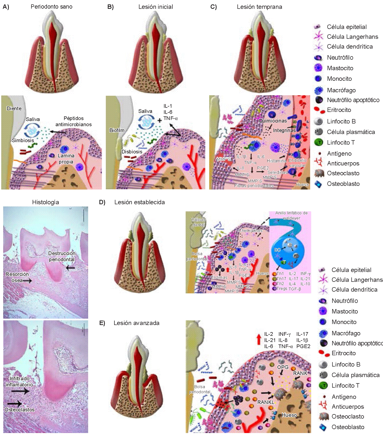 Mechanisms of inflammation in periodontal destruction