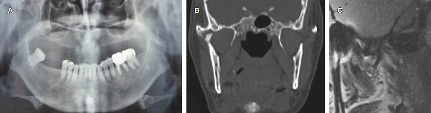 Reemplazo total de articulación temporomandibular en pacientes con ...