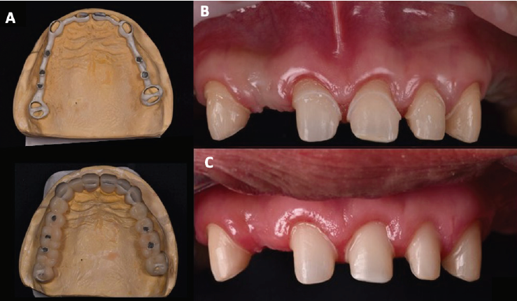 Complete oral rehabilitation of a patient with class II malocclusion: A ...